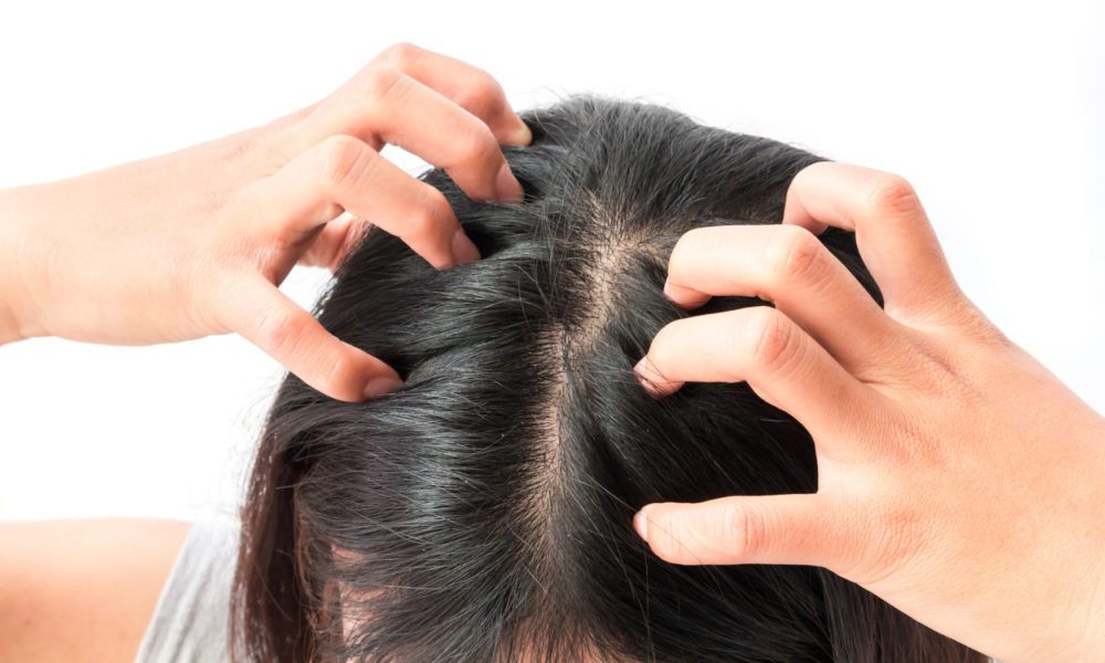 TIPS TO CURE DANDRUFF AND OTHER FUNGAL INFECTIONS